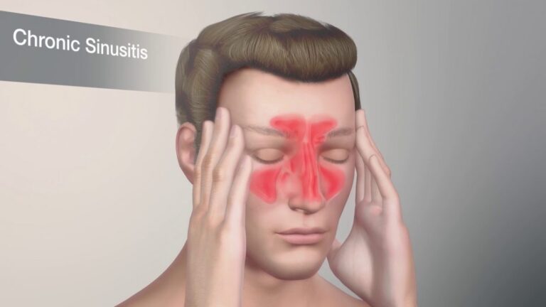 8 Dangerous Complications of Sinusitis, But 3 That Can Kill - Sleep ...